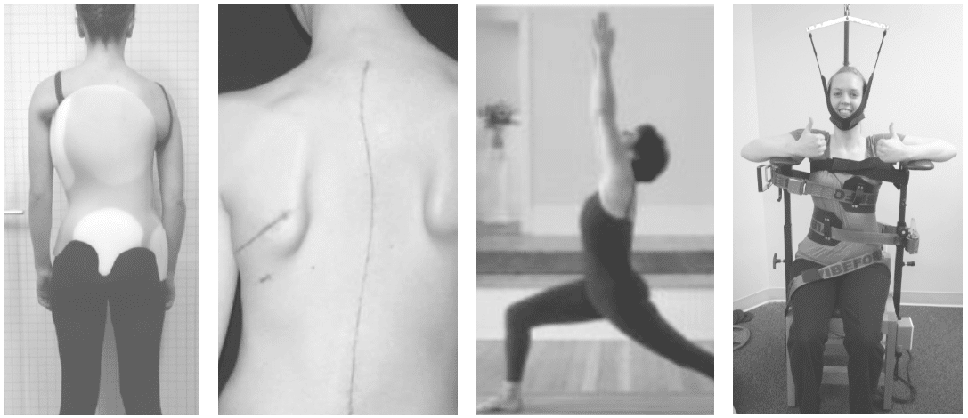 Scoliosis Treatment Options A Comprehensive Guide