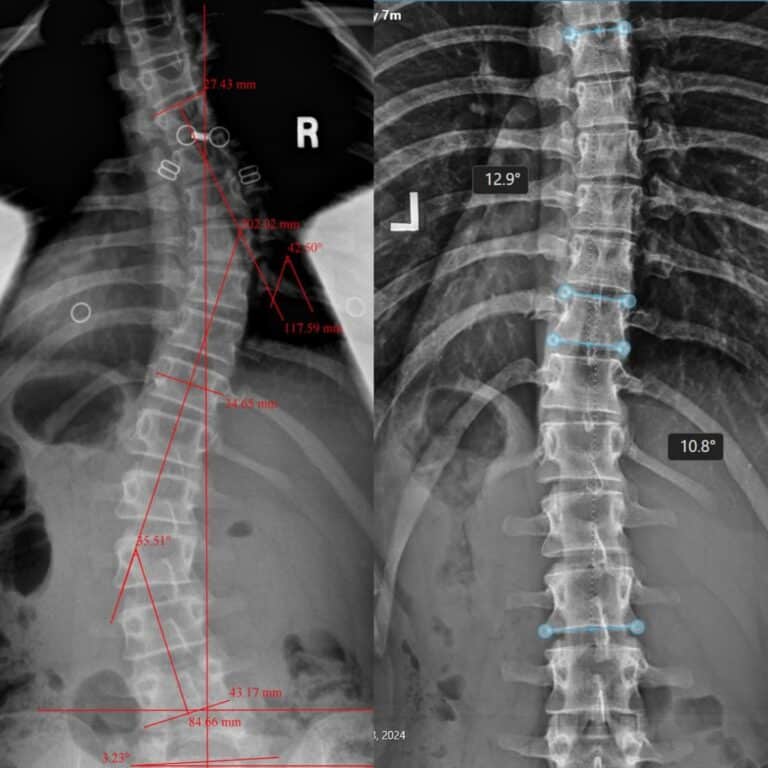 Strauss Scoliosis Correction: Keeping Patients Ahead Of The Curve