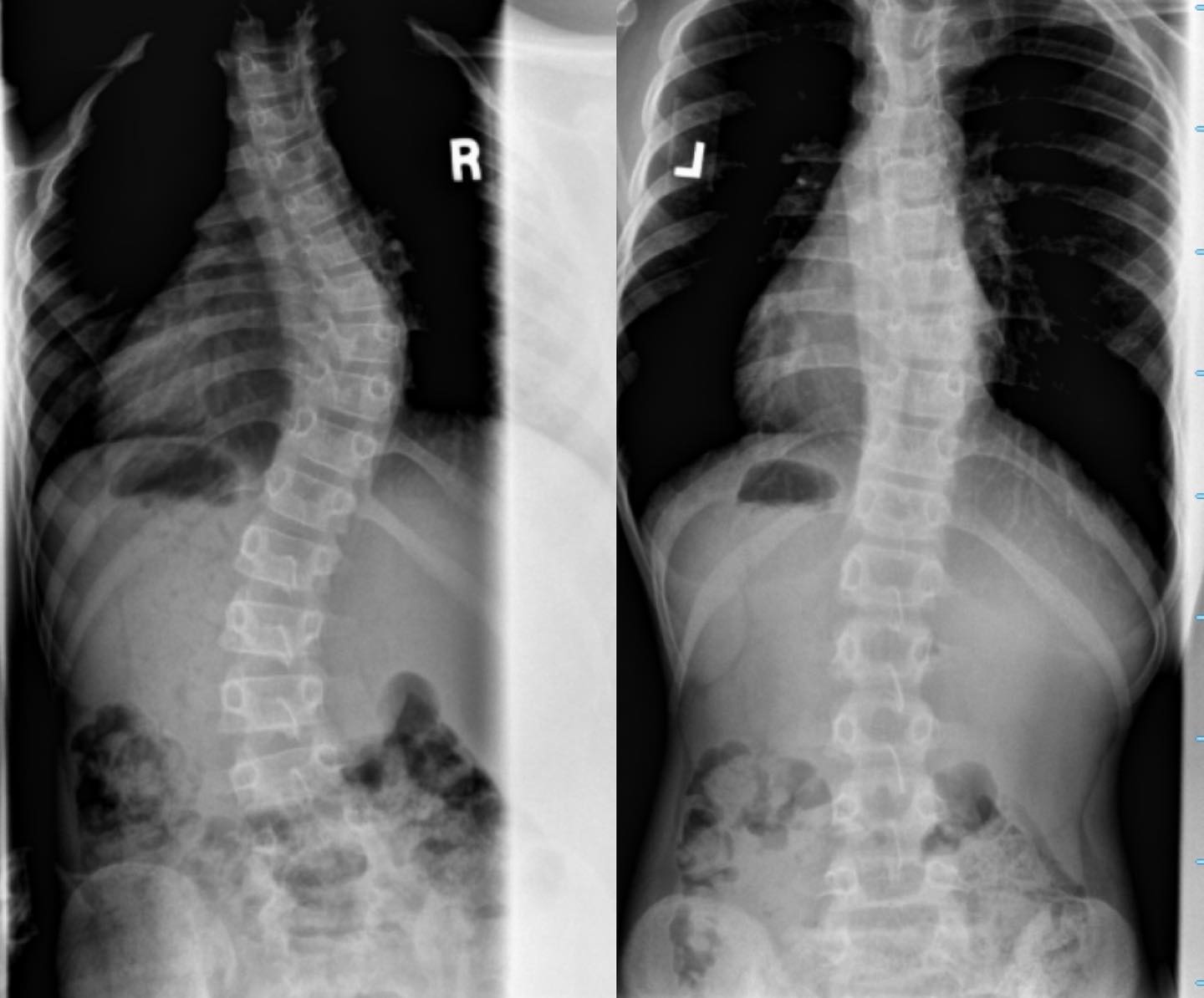 Strauss Scoliosis Correction: Keeping Patients Ahead Of The Curve