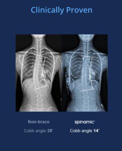 Strauss Scoliosis Correction: Keeping Patients Ahead Of The Curve